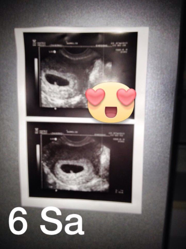 Echo de datation a 6 SA + 4, une bêtise?? - Echographie - connaître le ...