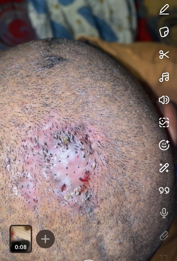 plaques inflammatoires ou chéloïdes - Psoriasis - Acné, psoriasis et ...