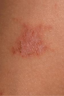 Très inquiète: petits boutons rouges sur fesses de ma fille a cause CL ...