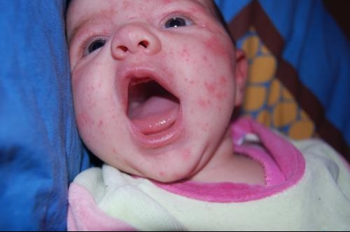 Votre loulou a-t-il déjà eu des plaques rouges comme ça? - Bébés de l ...