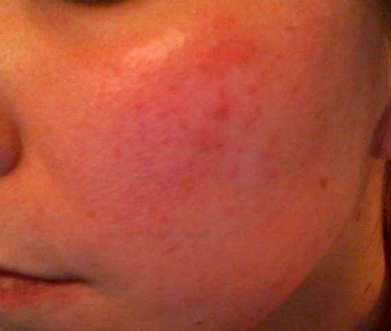 Acné? Rosacé? Psoriasis? Qu'est-ce que j'ai?