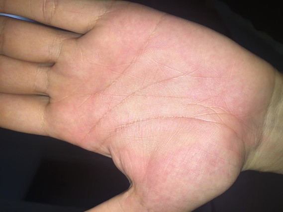 Démangeaisons/douleurs sur mains/doigts après travail + ganglions