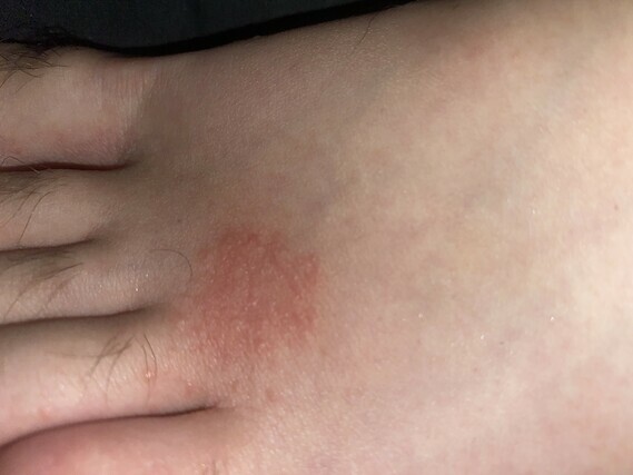 Pleins de Boutons rouge sur un pieds persistants - Acné, psoriasis et ...