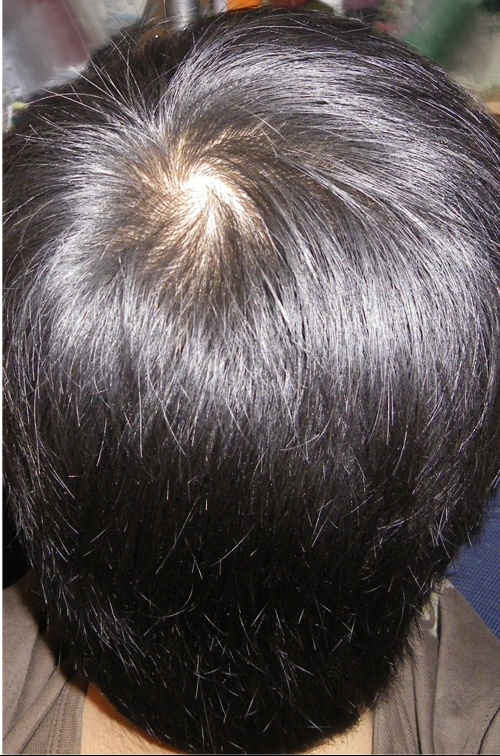 Trou arrière de la tête