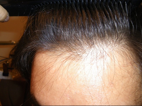 Trou arrière de la tête