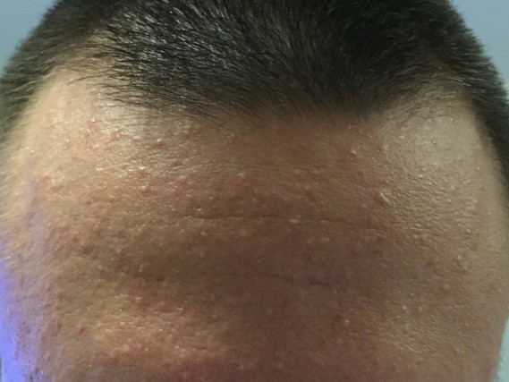 Boutons et éruptions dos/bras