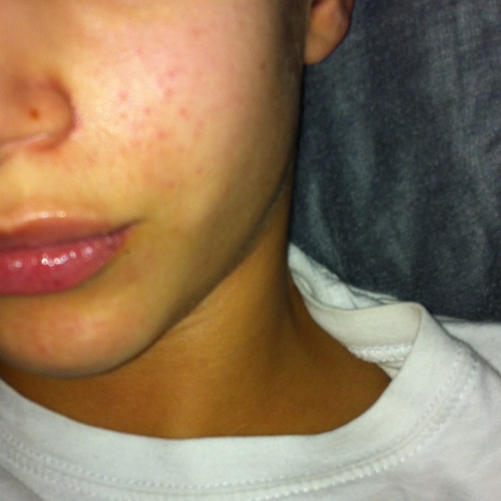 Petits boutons rouges (photos) Aidez-moi - Acné - Acné, psoriasis et ...