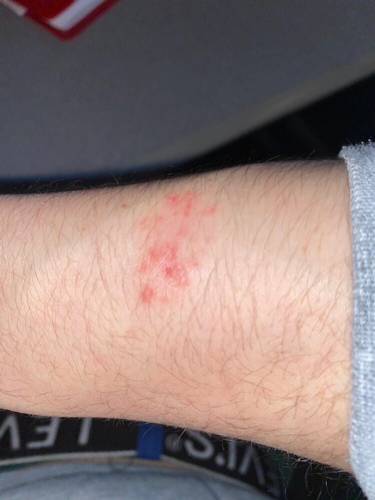 Eczema ou autres ?? - Acné, psoriasis et problèmes de peau - FORUM ...