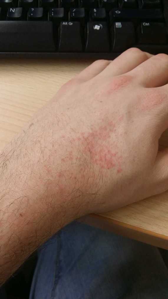 eruption cutanée ( taches rouges)