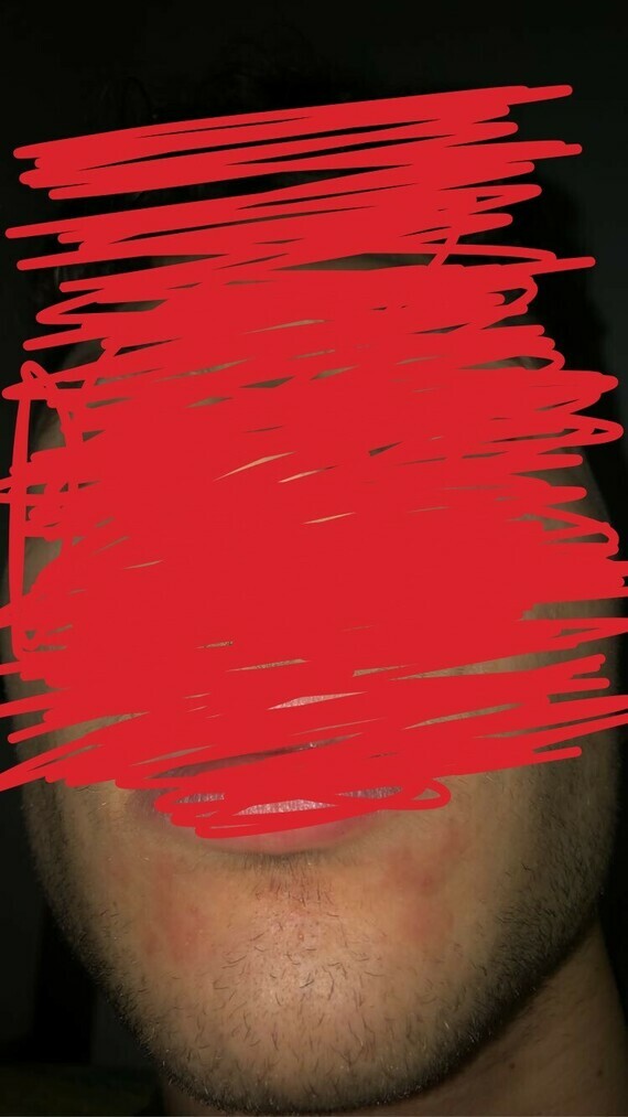 Plaques rouges sur le menton - Acné, psoriasis et problèmes de peau ...