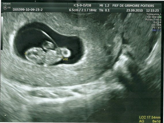 écho bizarre a 8SA, cordon ou jumeaux? - Echographie - connaître le ...