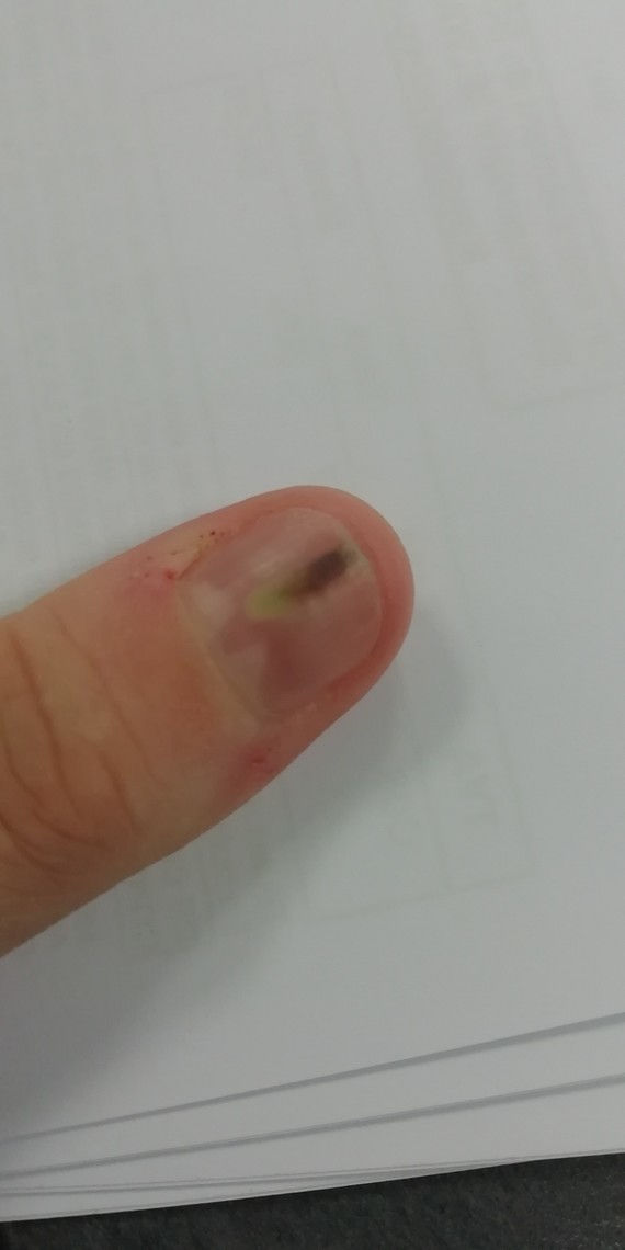 trait noir avec du jaune sous l'ongle du pouce