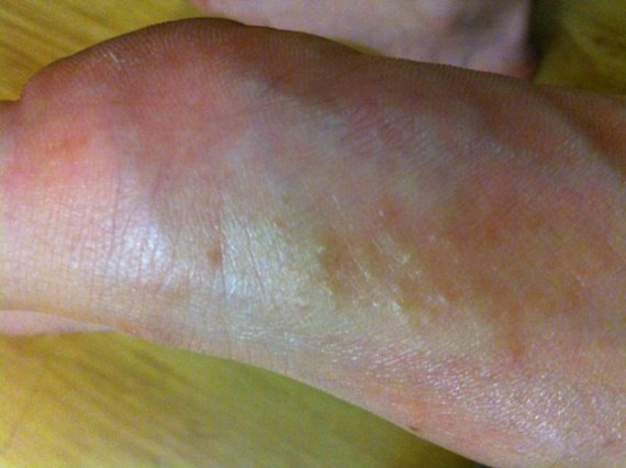 Petits boutons qui grattent sur le pied - Acné, psoriasis et problèmes ...