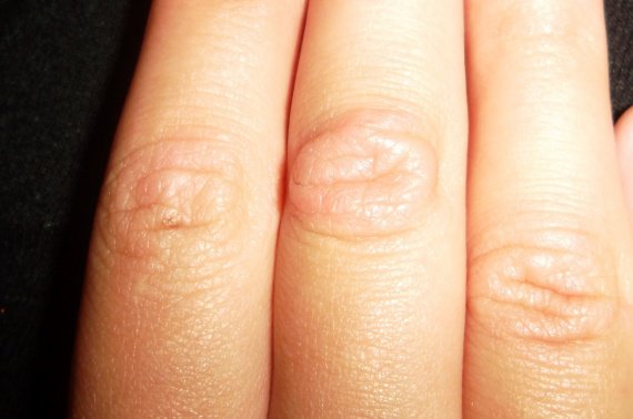 Plaques/boutons sur les doigts