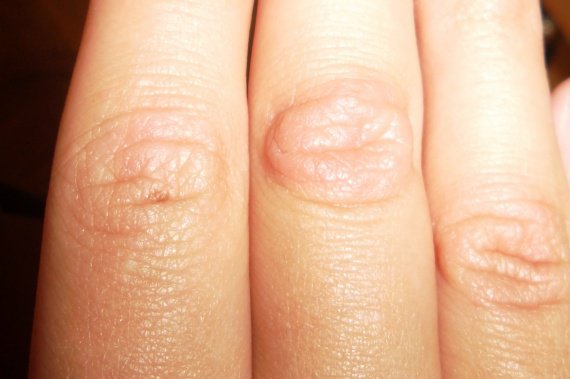 Plaques/boutons sur les doigts