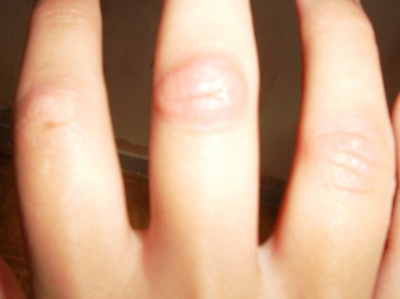 Plaques/boutons sur les doigts