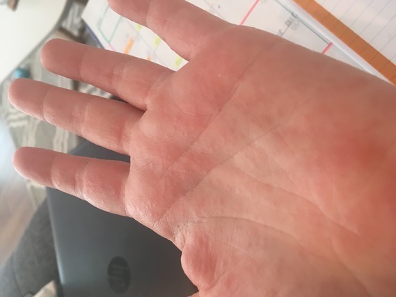 Petits boutons sur la paume des mains et des Pieds