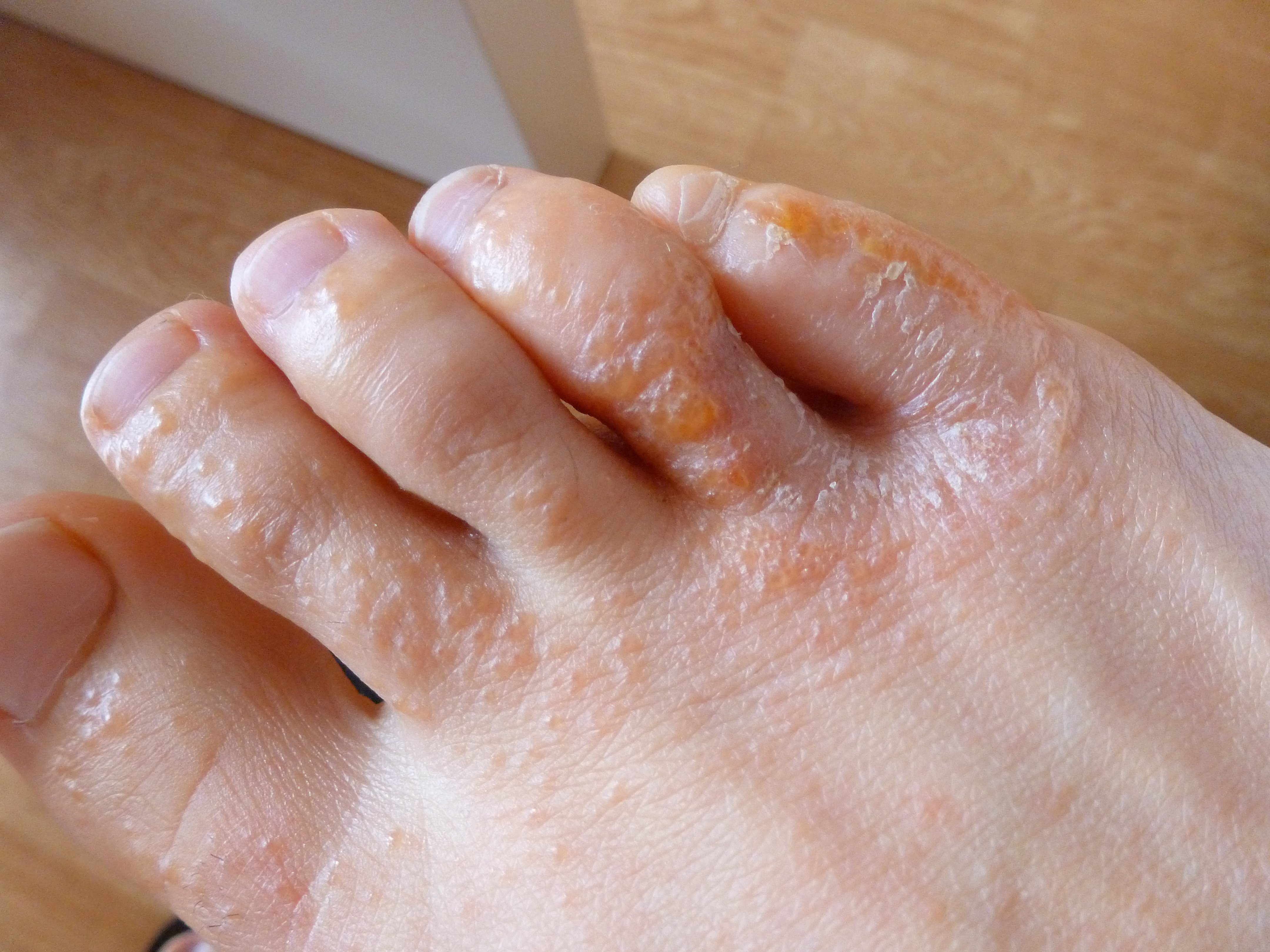 dysidrose - définition - C'est quoi