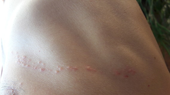 plaque boutons jambe quel problème de peau?