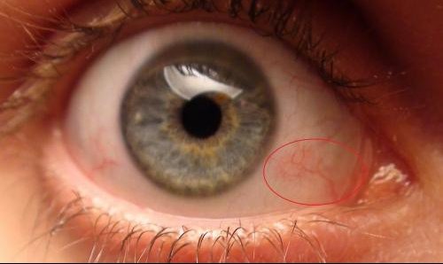 Oeil rouge, pinguecula