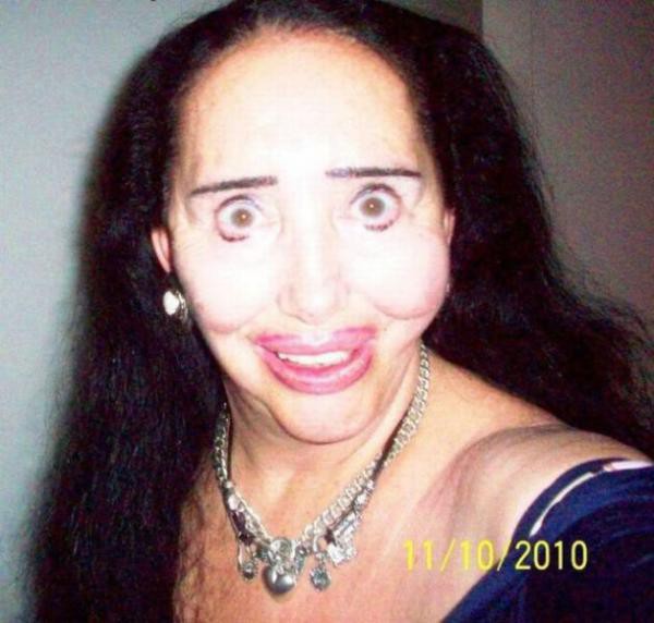 Michaela-Romanini avant et apres chirurgie esthetique - Chirurgie ...