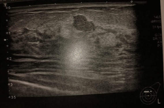 Adenofibrome très douloureux