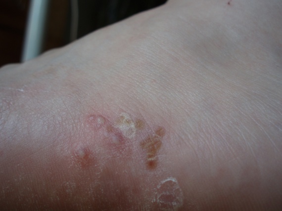 croûte, plaque rouge et petites cloques sur les pieds