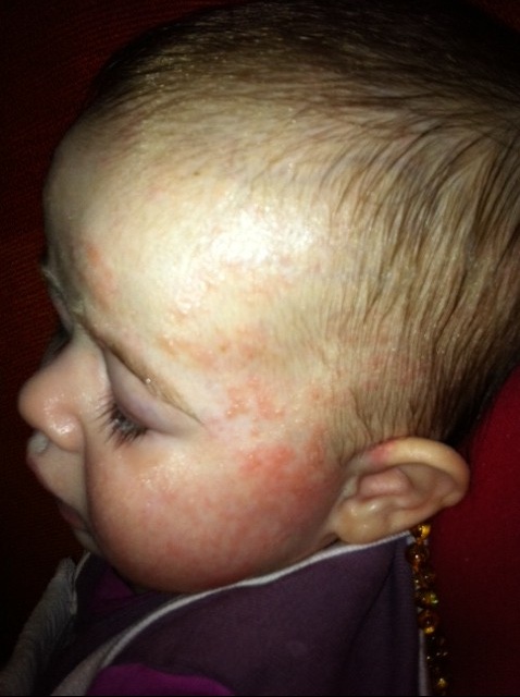 eczema depuis ses 3 mois perdue!!!