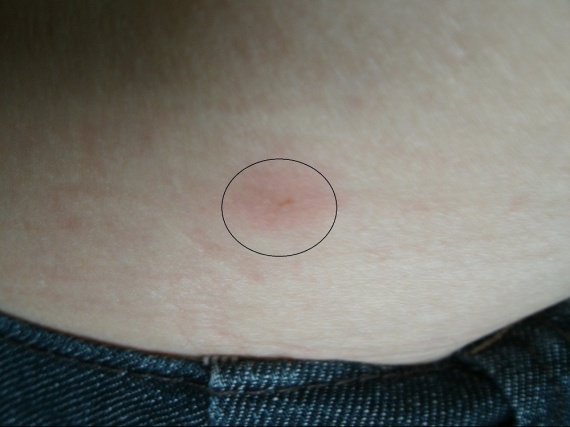 Boutons sur le corps et plaques rouges