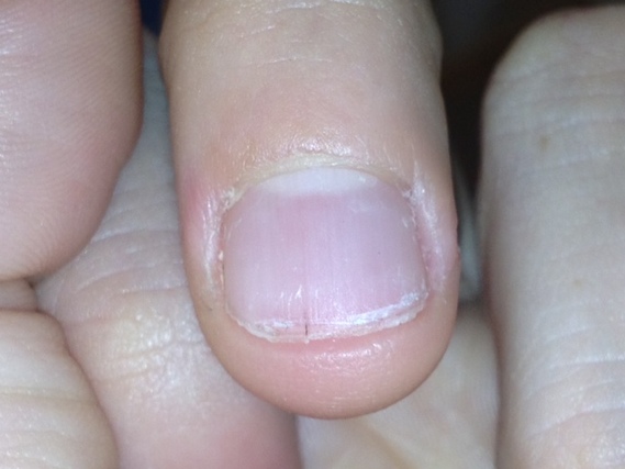 Trait noir sous les ongles