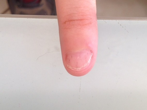 Trait noir sous les ongles
