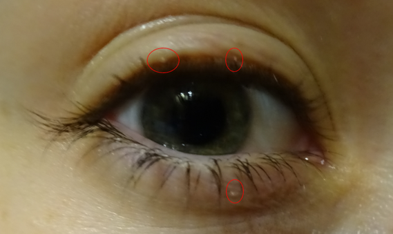 Étrange boutons sur la paupière - Forum libre Santé - FORUM Santé ...
