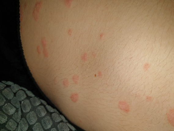 plaques rouge sur le corps help!!!