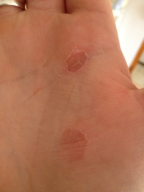 Problème de peau sur les mains