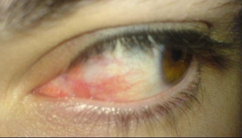 S.O.S. Yeux rouges et douleurs - Myopie, cataracte et problèmes de vue ...