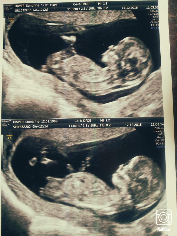 Qui a testé Babygram, Gendologists ou Genderexperts? - Echographie ...