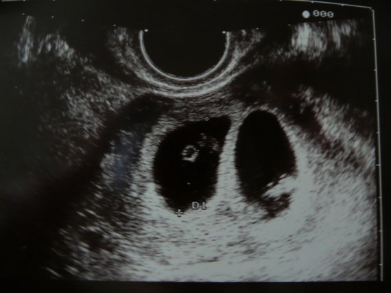 échographie 8SA de jumeaux