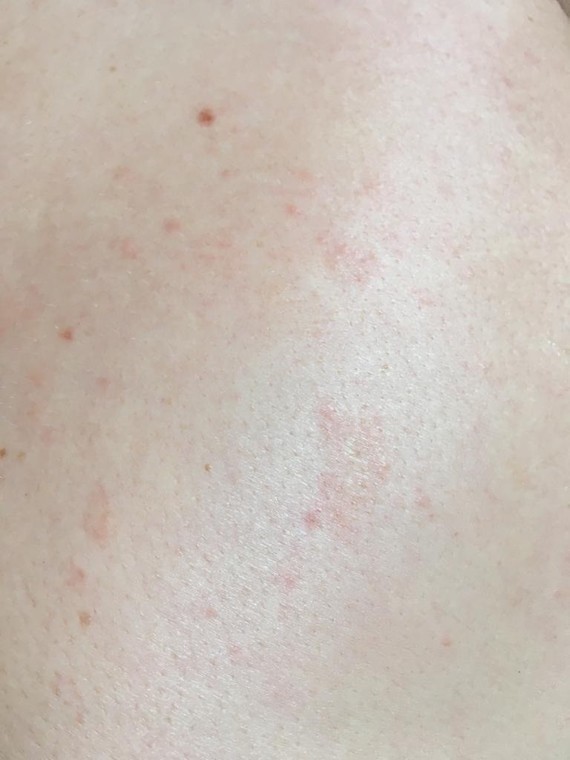 Tâches rouges haut du corps, eczema