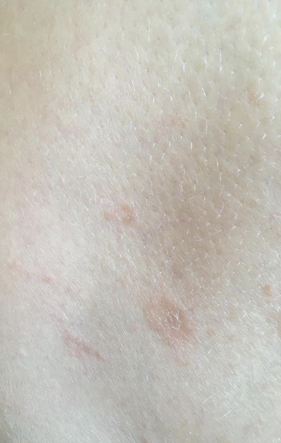 Tâches rouges haut du corps, eczema