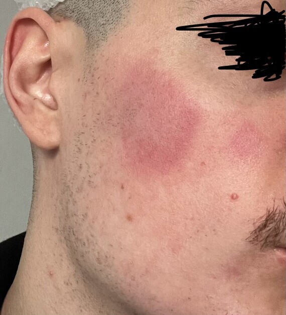 Rougeur au visage (joue) urgent - Acné - Acné, psoriasis et problèmes ...