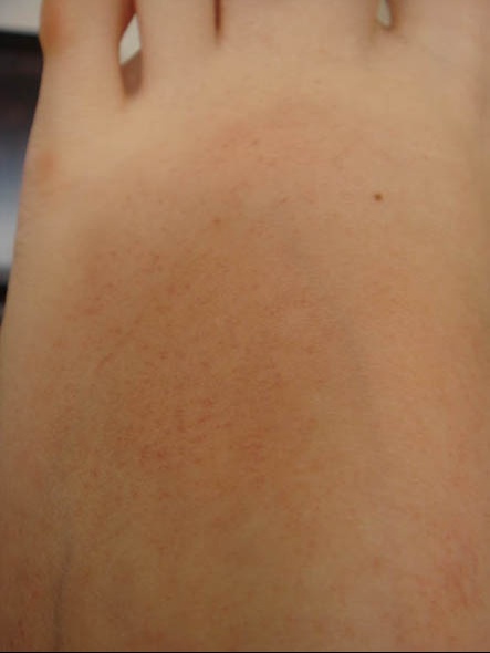 "Rougeurs" sur le pied + jambe