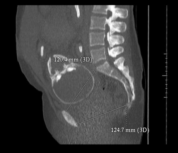 PELVIMETRIE ?? - Les juinettes 2010 - Futures mamans - FORUM Grossesse ...