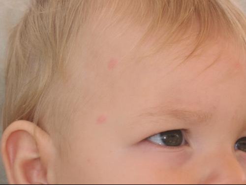 Petite maladie ici aussi!!!! Boutons en photos...vos avis!!! - Mamans ...