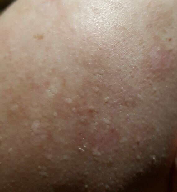 Excroissance de peau sur mes epaule - Acné, psoriasis et problèmes de ...