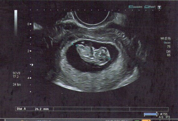 Vos échos entre 7 sa et 8 sa - Echographie - connaître le sexe de votre ...