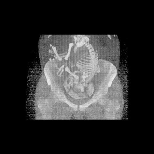 Pelvimétrie (radio du bassin): qui doit en faire une?