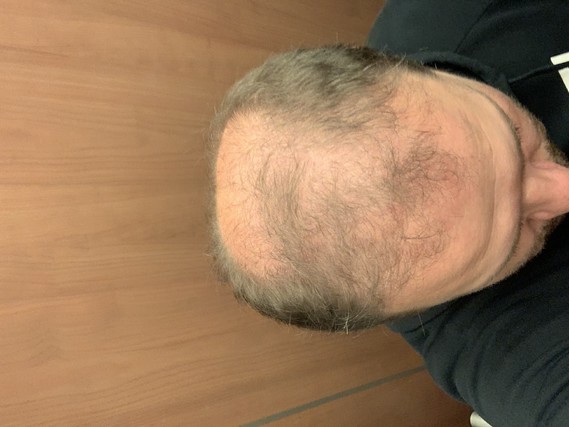 Calvitie : Ma Greffe de cheveux Turquie FUE Août 2019 Retour d’expérience