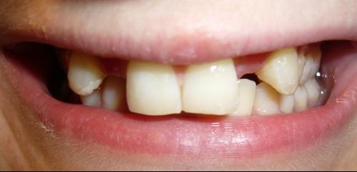 Agénésie dentaire - Problèmes dentaires - FORUM Santé - Doctissimo