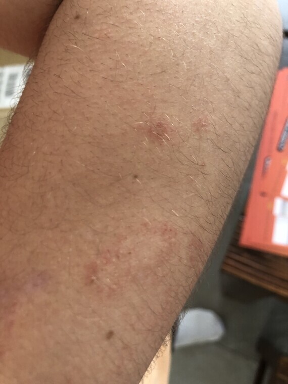 plaques rouges étranges - Eczéma - Acné, psoriasis et problèmes de peau ...